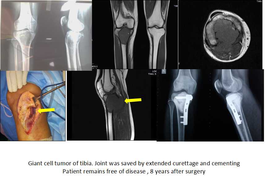 Top benign bone tumor surgery in Delhi best surgical oncologist soft ...