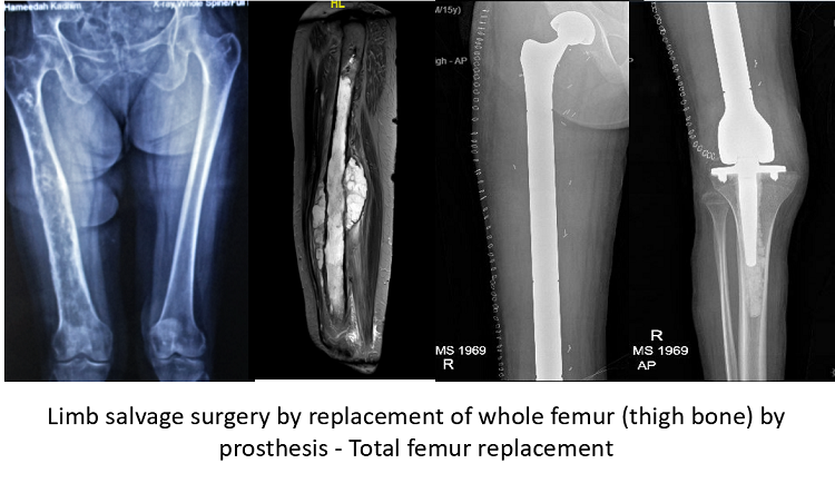 Top benign bone tumor surgery in Delhi best surgical oncologist soft ...