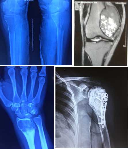 Best giant cell tumor bone specialist in Delhi giant cell tumor foot ...