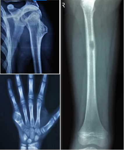 Benign bone tumor treatment in Delhi benign bone tumor surgery ...